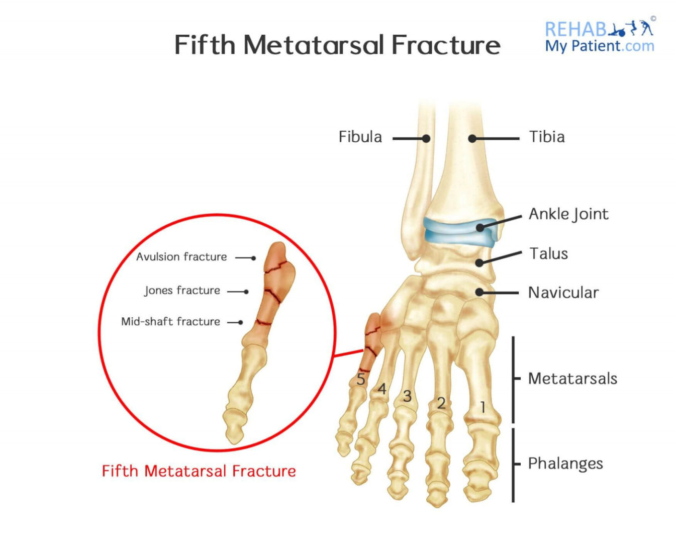 Fracture of the fifth metatarsal. - Farnsworth Orthopedic Physical Therapy